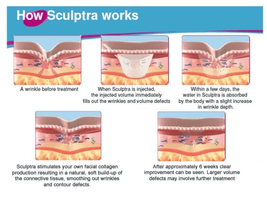 Sculptra: The Secret to Rejuvenated Skin - Afya Medical Spa