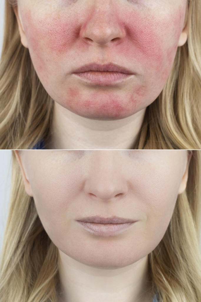 Rosacea: Causes, Symptoms, and Treatment Strategies - Afya Medical Spa