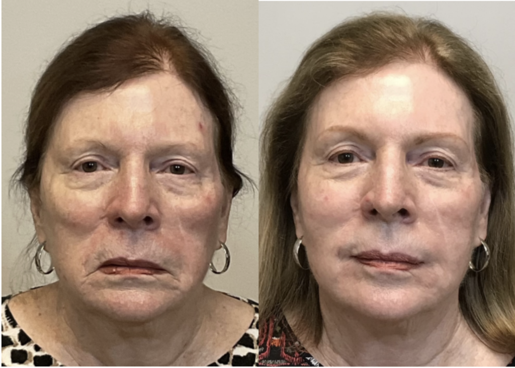 Radiesse: 10 Compelling Reasons This is The Treatment to Get! - Afya ...